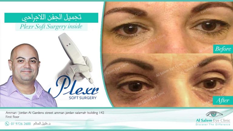 بلكسر ، شد الجفن بدون جراحة (Plexr) - أ.د. خليل السالم