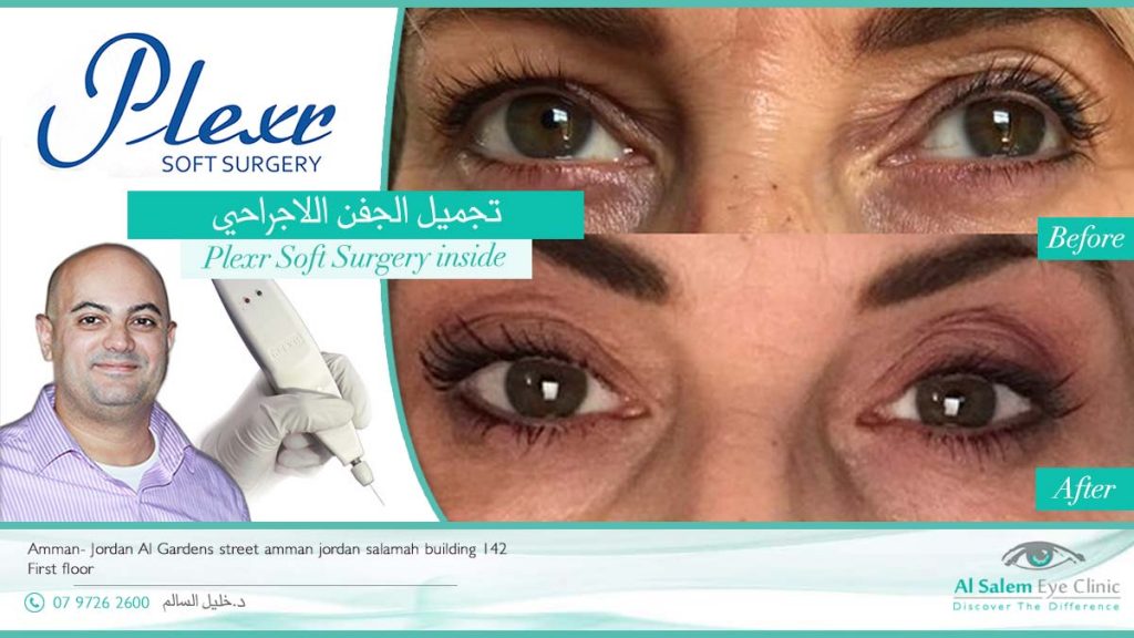 بلكسر ، شد الجفن بدون جراحة (Plexr) - أ.د. خليل السالم