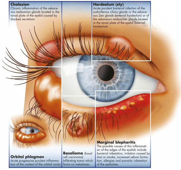 Eyelid Lesions For medical students - أ.د. خليل السالم