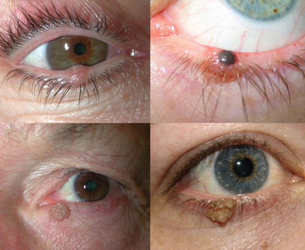Eyelid Lesions For medical students - أ.د. خليل السالم